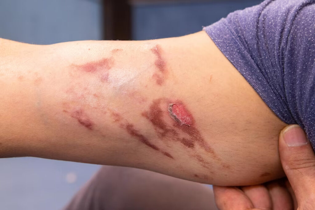 Comprendre les cicatrices de brûlure : les différents types et leurs ...