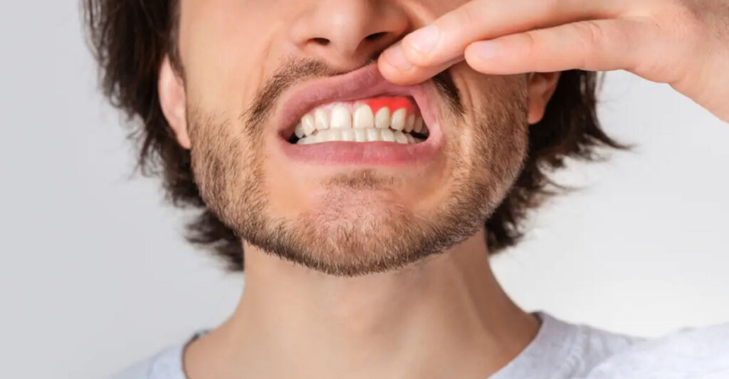 Gencive gonflée : Comment soulager la douleur avec des traitements naturels