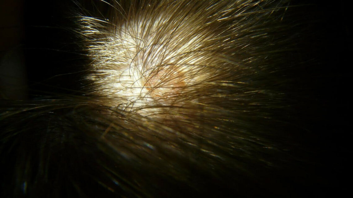 L'injection de PRP pour les cheveux : une alternative efficace pour ...